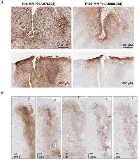 Characterization of Active MMP9 in Chronic Inflammatory Diseases Using ...