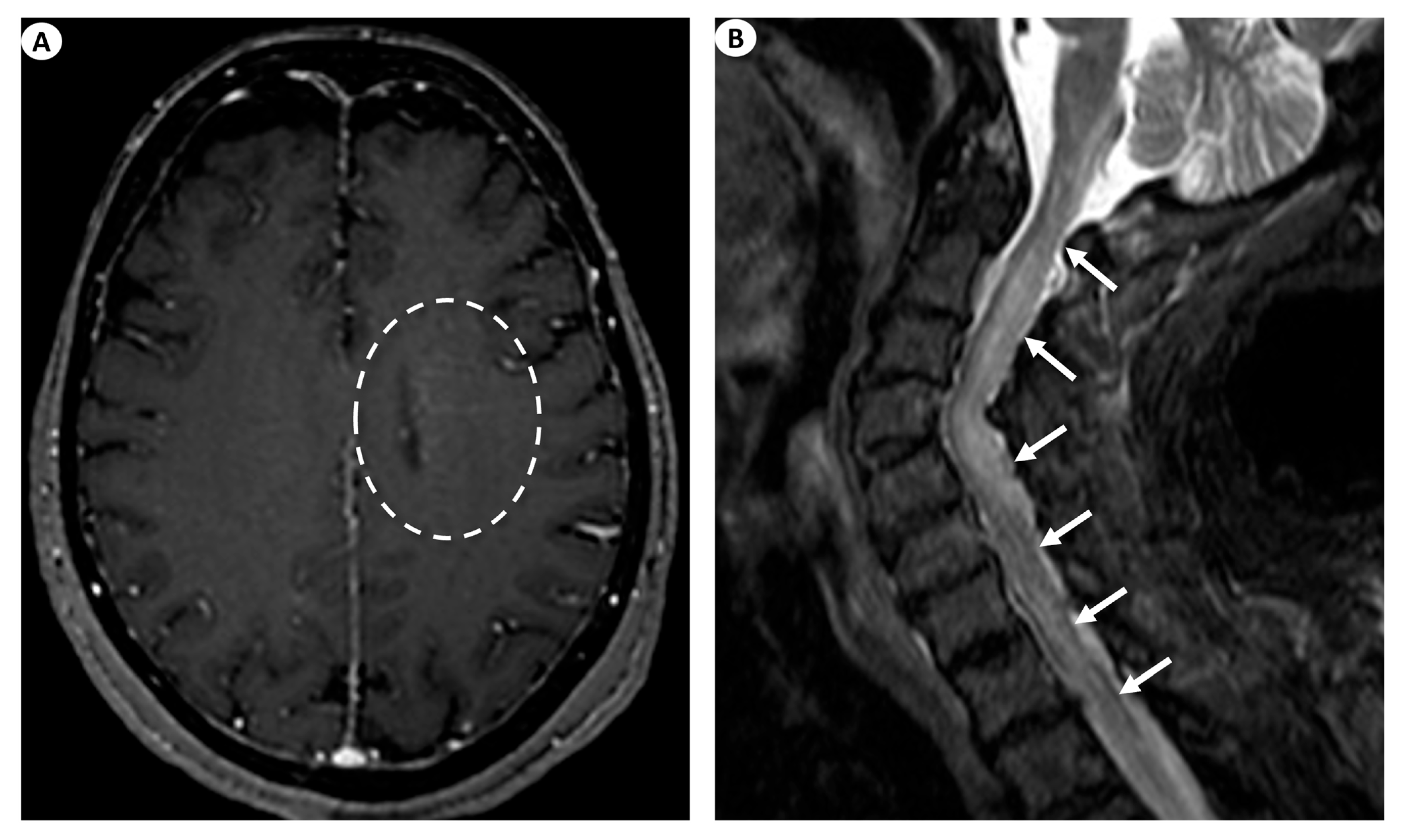 Unveiling GFAP Astrocytopathy: Insights from Case Studies and a ...