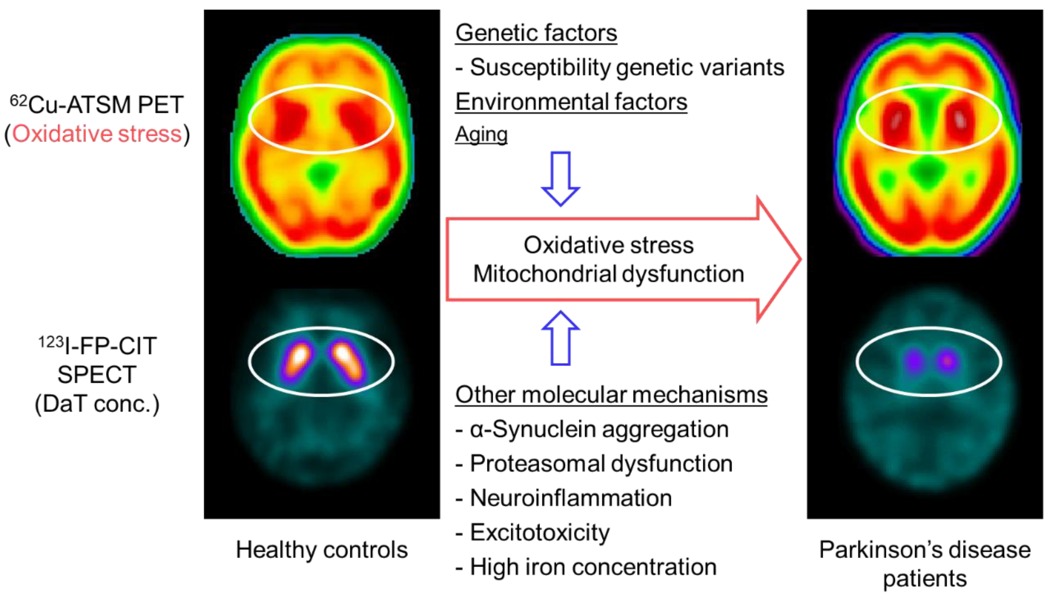 PET Imaging for Oxidative Stress in Neurodegenerative Disorders ...