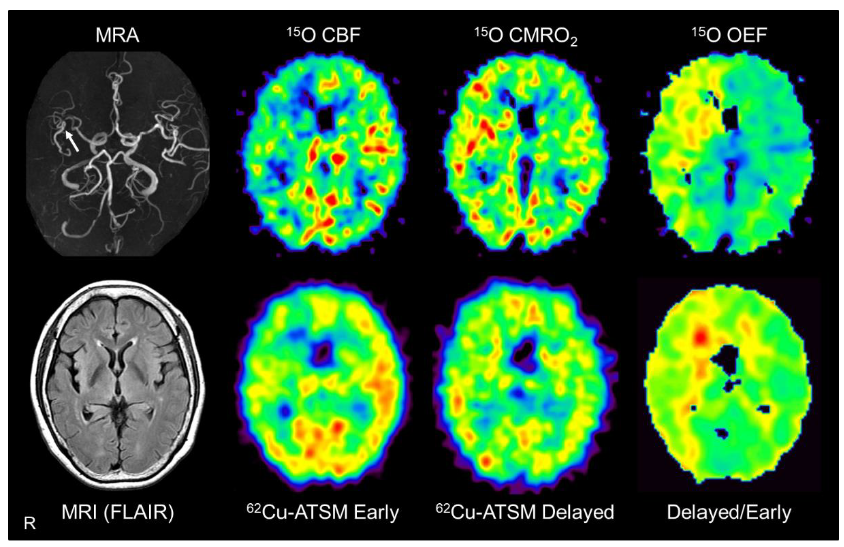 PET Imaging for Oxidative Stress in Neurodegenerative Disorders ...