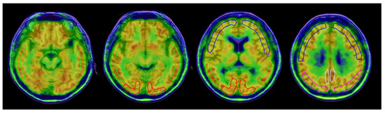 Cerebral Oxidative Stress in Early Alzheimer’s Disease Evaluated by ...