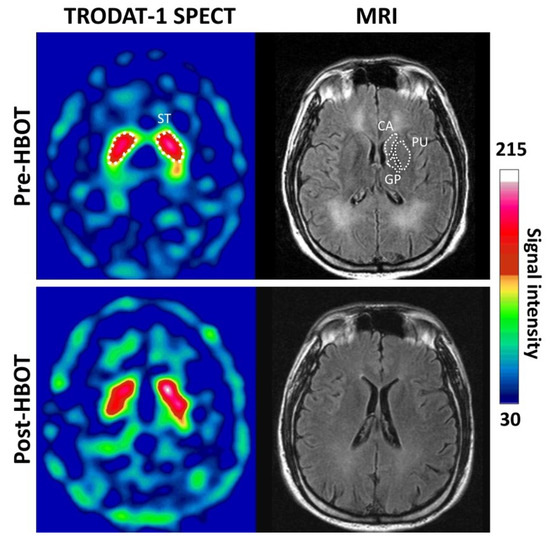 Antioxidants | Free Full-Text | Multi-Modal Synergistic 99mTc-TRODAT-1 SPECT and MRI for ...