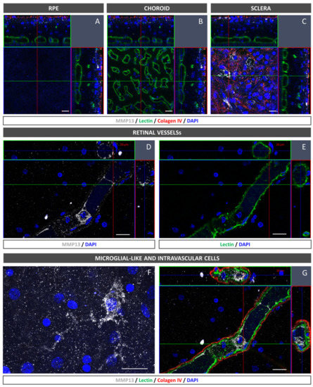 Matrix Metalloproteinase 13 Is Associated with Age-Related Choroidal ...