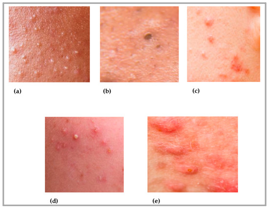 Tea Tree Oil: Properties and the Therapeutic Approach to Acne—A Review