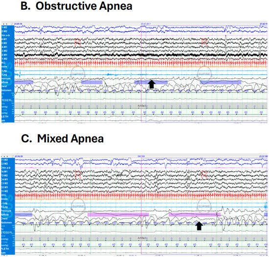 Apnea of Prematurity and Oxidative Stress: Potential Implications