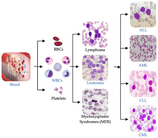 A Review of Deep Learning Techniques for Leukemia Cancer Classification Based on Blood Smear Images