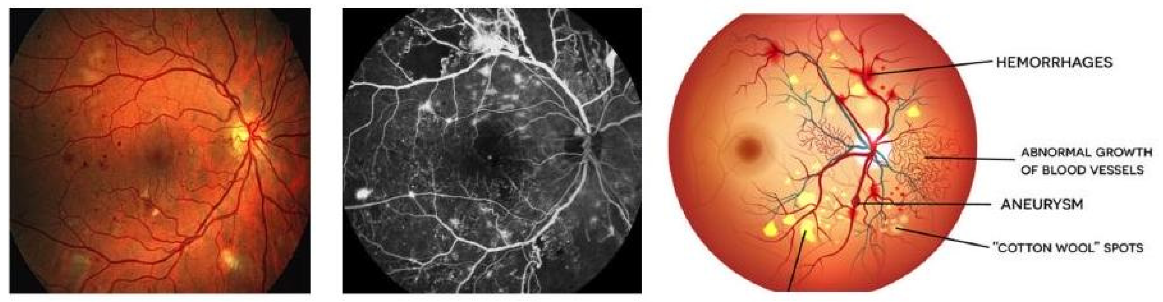 Application of Deep Learning Framework for Early Prediction of Diabetic ...