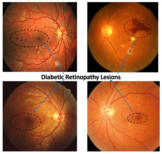 Application of Deep Learning Framework for Early Prediction of Diabetic Retinopathy