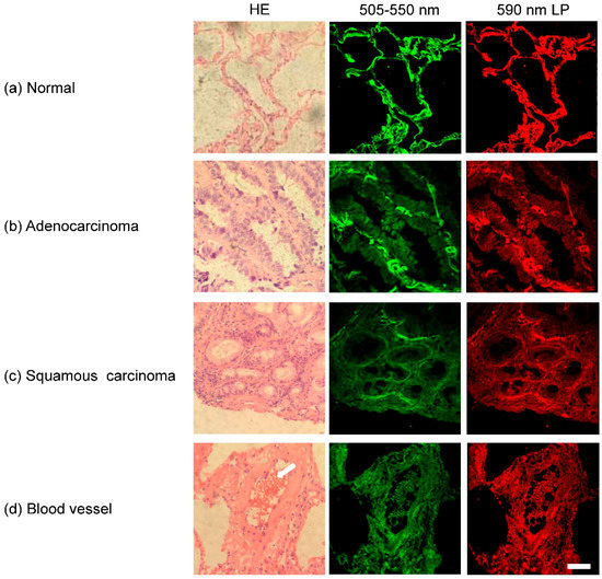 Autofluorescence Imaging and Spectroscopy of Human Lung Cancer