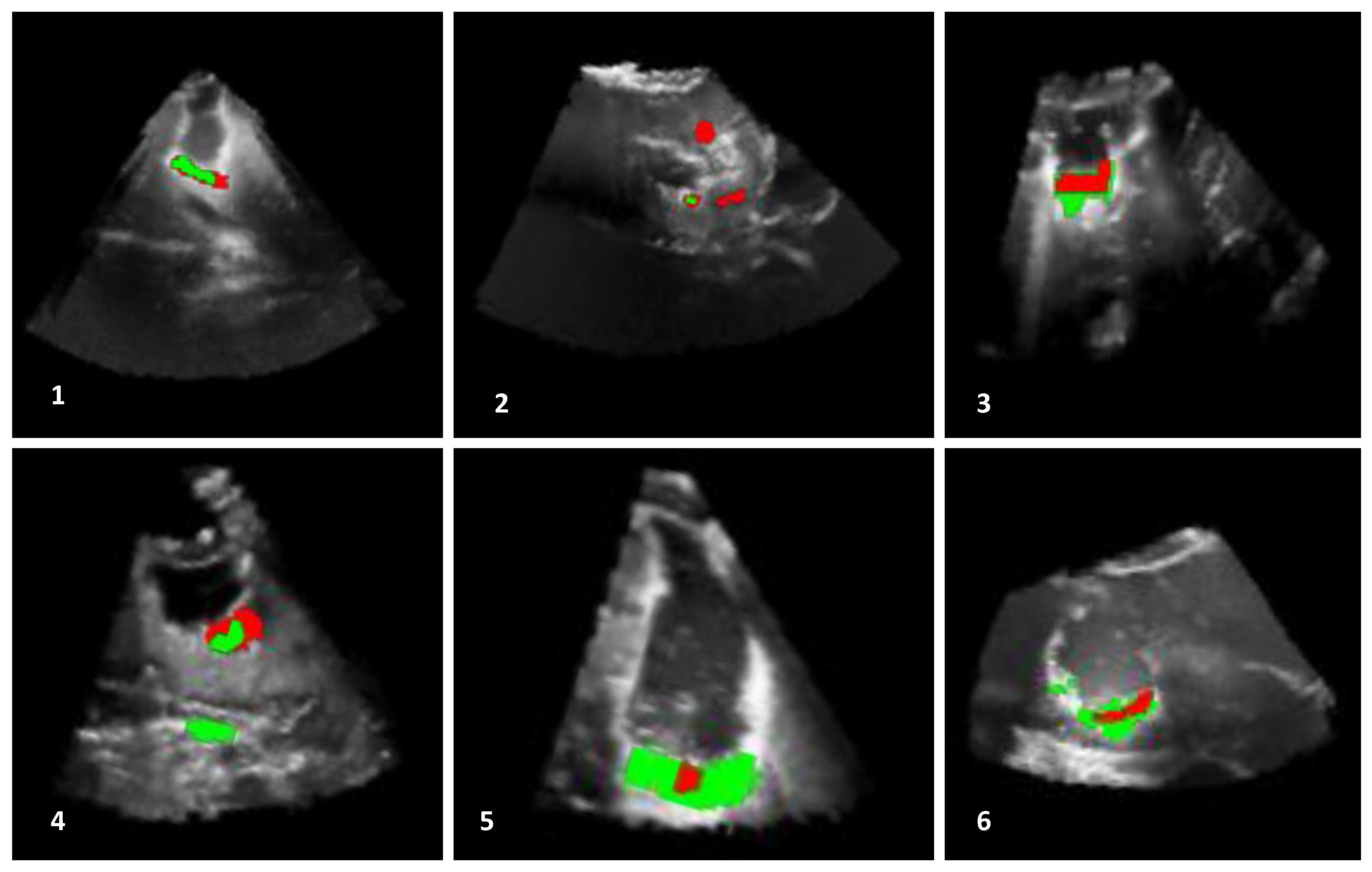 Fusion of Intraoperative 3D B-mode and Contrast-Enhanced Ultrasound ...