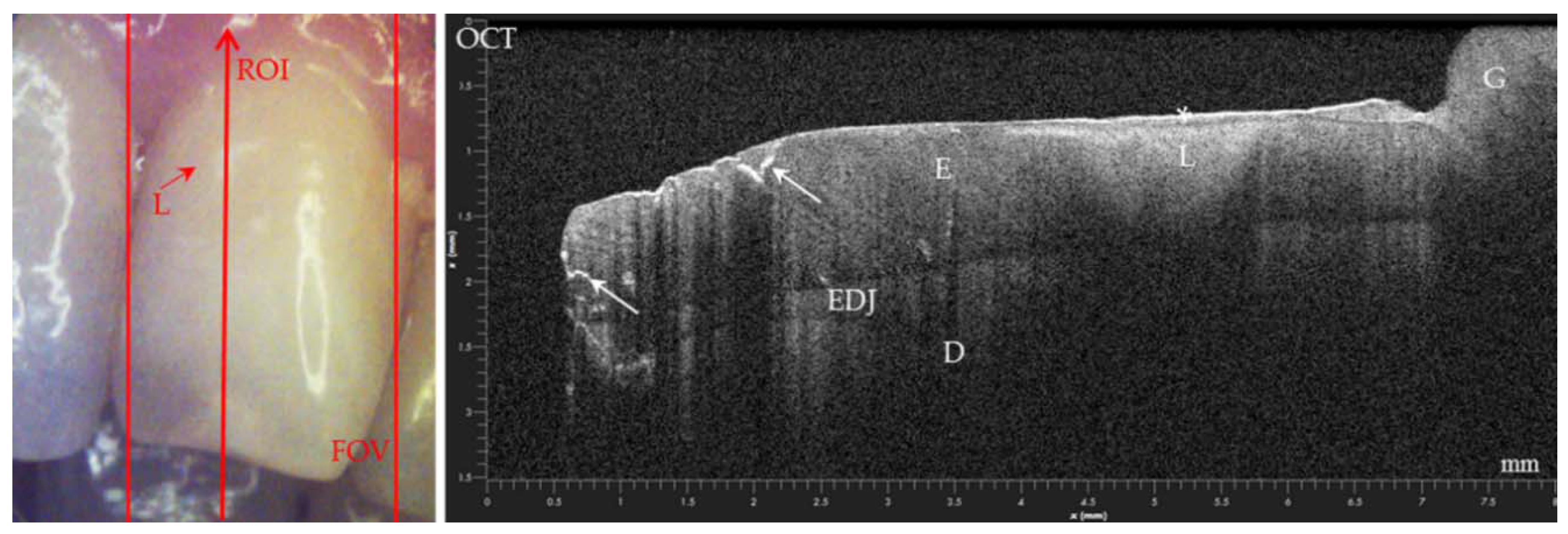 Dental Applications of Optical Coherence Tomography (OCT) in Cariology
