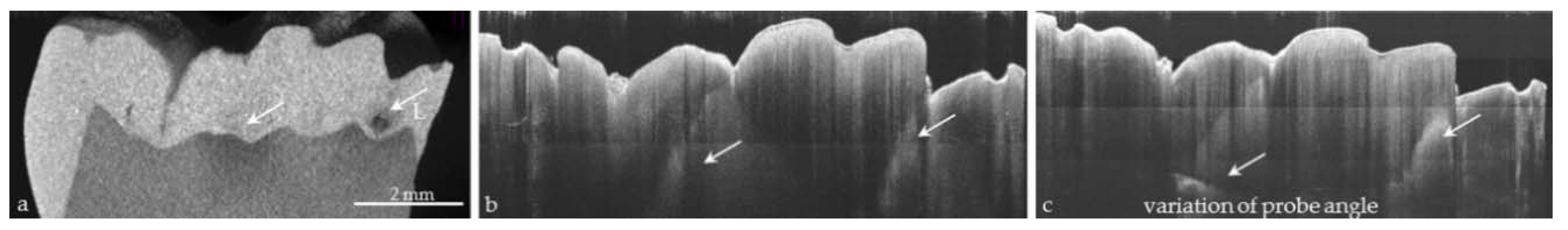 Dental Applications of Optical Coherence Tomography (OCT) in Cariology