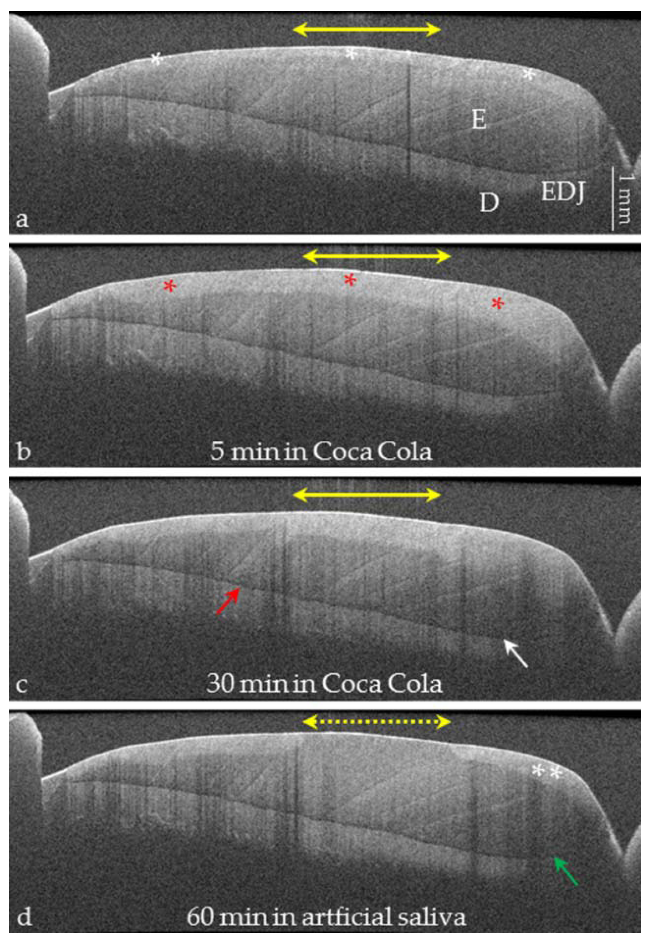 Dental Applications of Optical Coherence Tomography (OCT) in Cariology