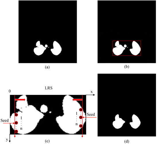 An Automated Segmentation Method for Lung Parenchyma Image Sequences Based on Fractal Geometry ...