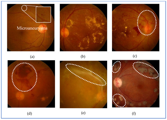 Applied Sciences Free Full Text Automated Diabetic Retinopathy