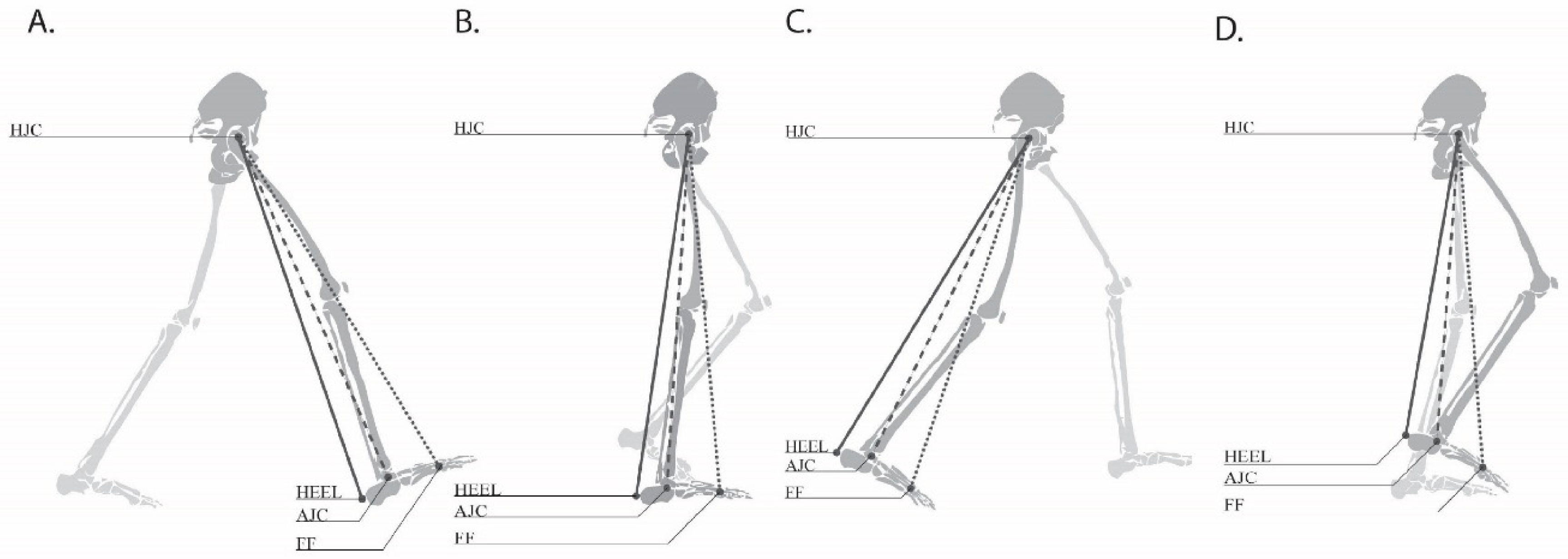 Correlation between Gait Asymmetry and Leg Length Discrepancy—What Is ...