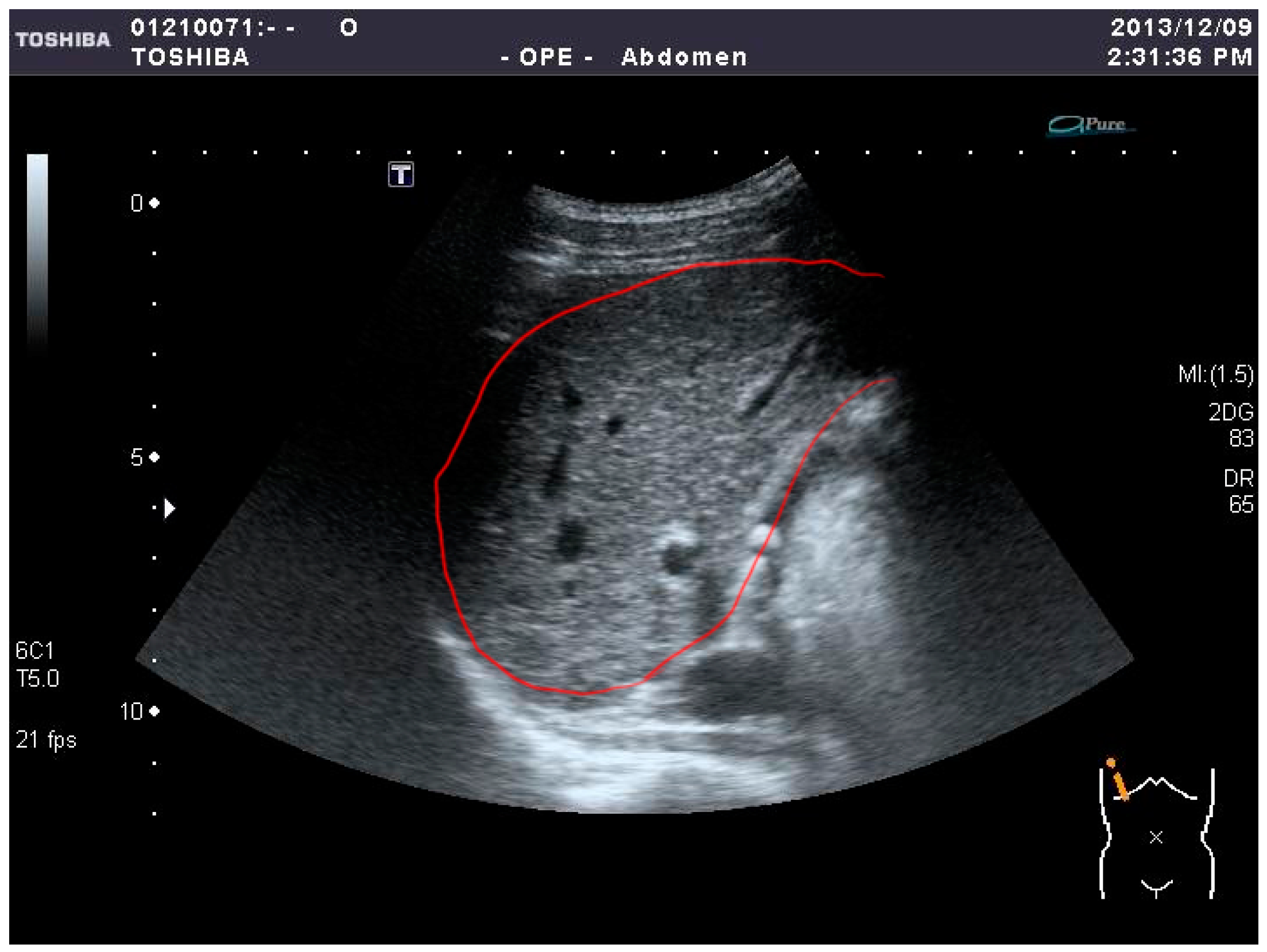 Classification of Liver Diseases Based on Ultrasound Image Texture Features