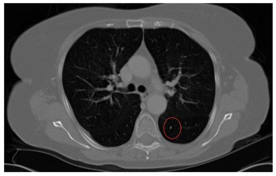 Using Double Convolution Neural Network for Lung Cancer Stage Detection