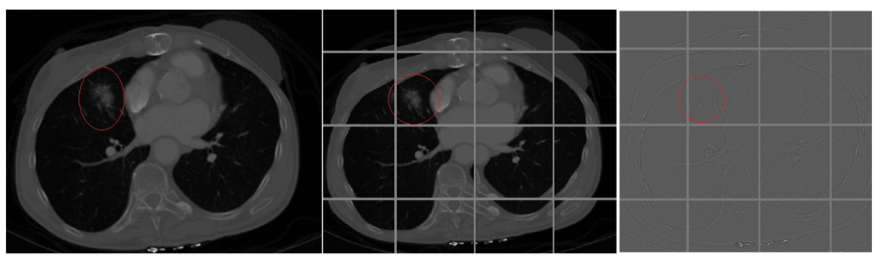 Using Double Convolution Neural Network for Lung Cancer Stage Detection