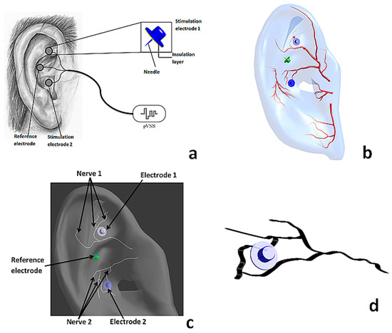 Sensitivity Analysis of a Numerical Model for Percutaneous Auricular ...