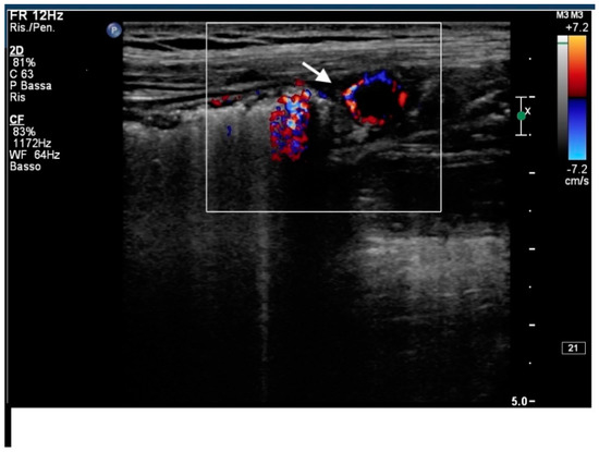Eosinophilic Gastroenteritis with Appendix Involvement: Role of ...
