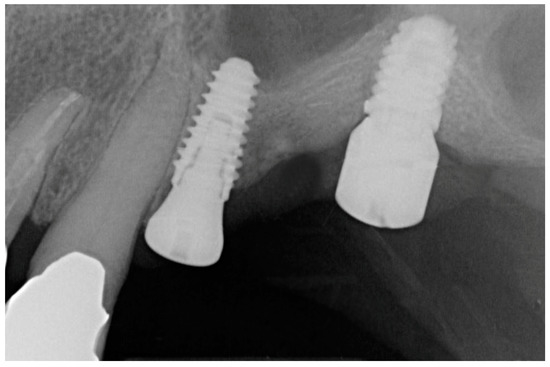 Fresh Frozen Allogeneic Bone Block in Maxillary Sinus Floor Elevation ...