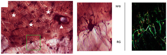Fresh Frozen Allogeneic Bone Block in Maxillary Sinus Floor Elevation ...