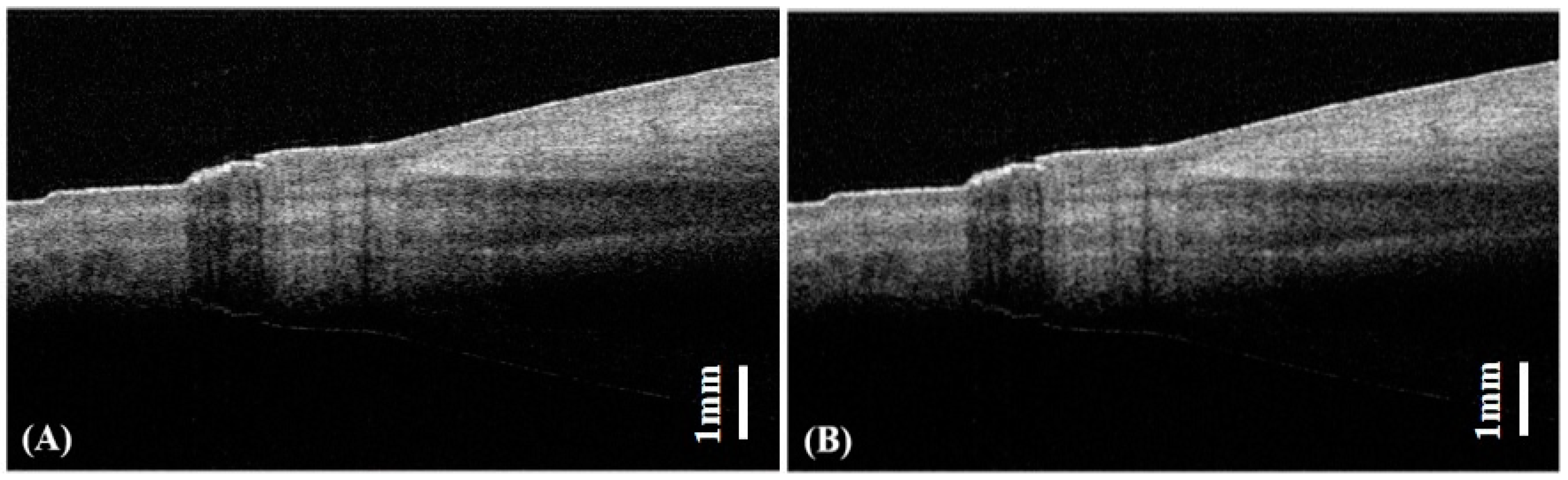 Acceleration of OCT Signal Processing with Lookup Table Method for ...