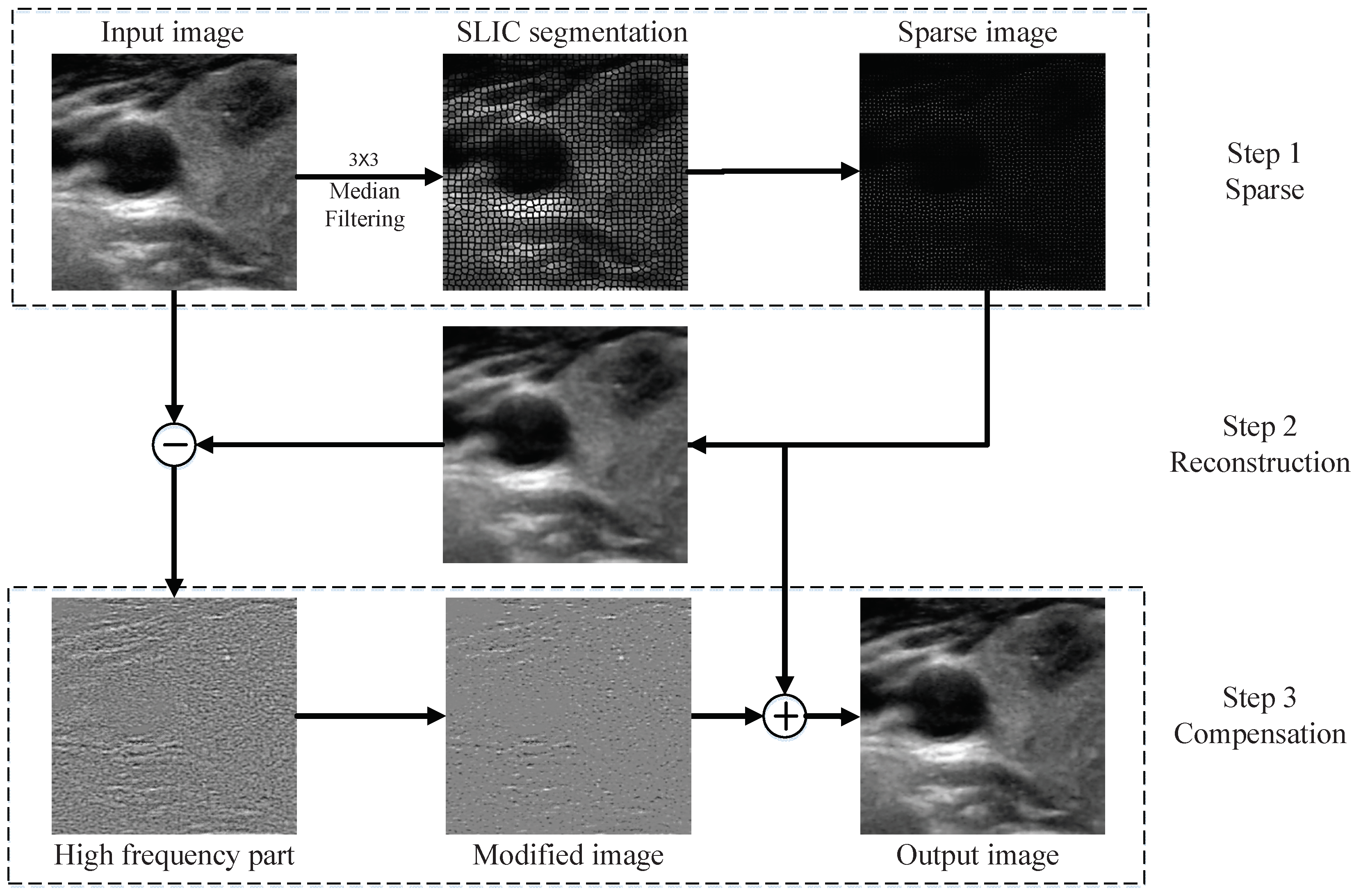 A New Ultrasound Speckle Reduction Algorithm Based on Superpixel Segmentation and Detail ...