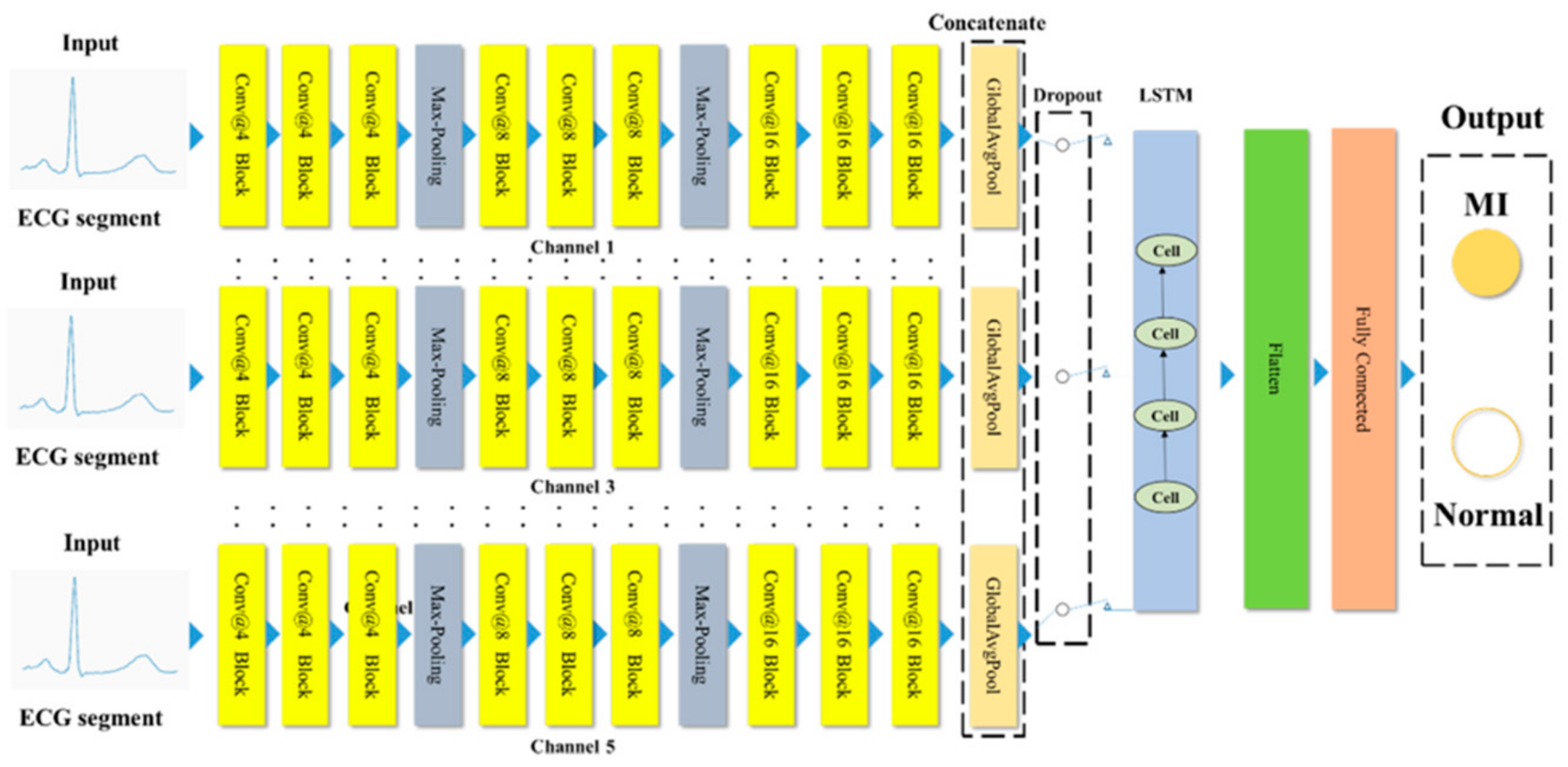 Myocardial Infarction Classification Based on Convolutional Neural Network and Recurrent Neural ...