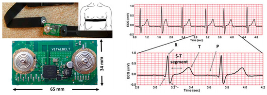 Monitoring of the Human Body Signal through the Internet of Things (IoT ...