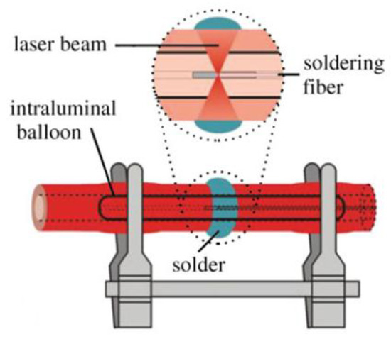 Overview on the Evolution of Laser Welding of Vascular and Nervous Tissues