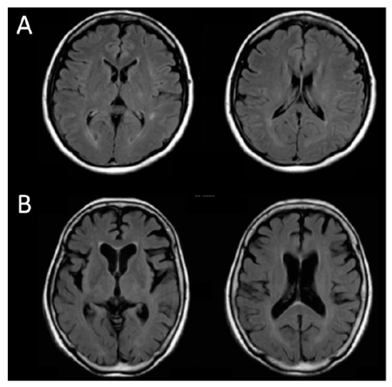 Effects of Aging, Cognitive Dysfunction, Brain Atrophy on Hemoglobin ...