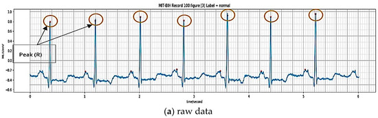An Automated ECG Beat Classification System Using Deep Neural Networks ...