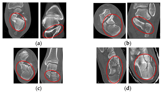 Real-Time Automated Segmentation and Classification of Calcaneal ...