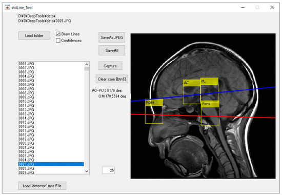 Automatic Detection of a Standard Line for Brain Magnetic Resonance ...