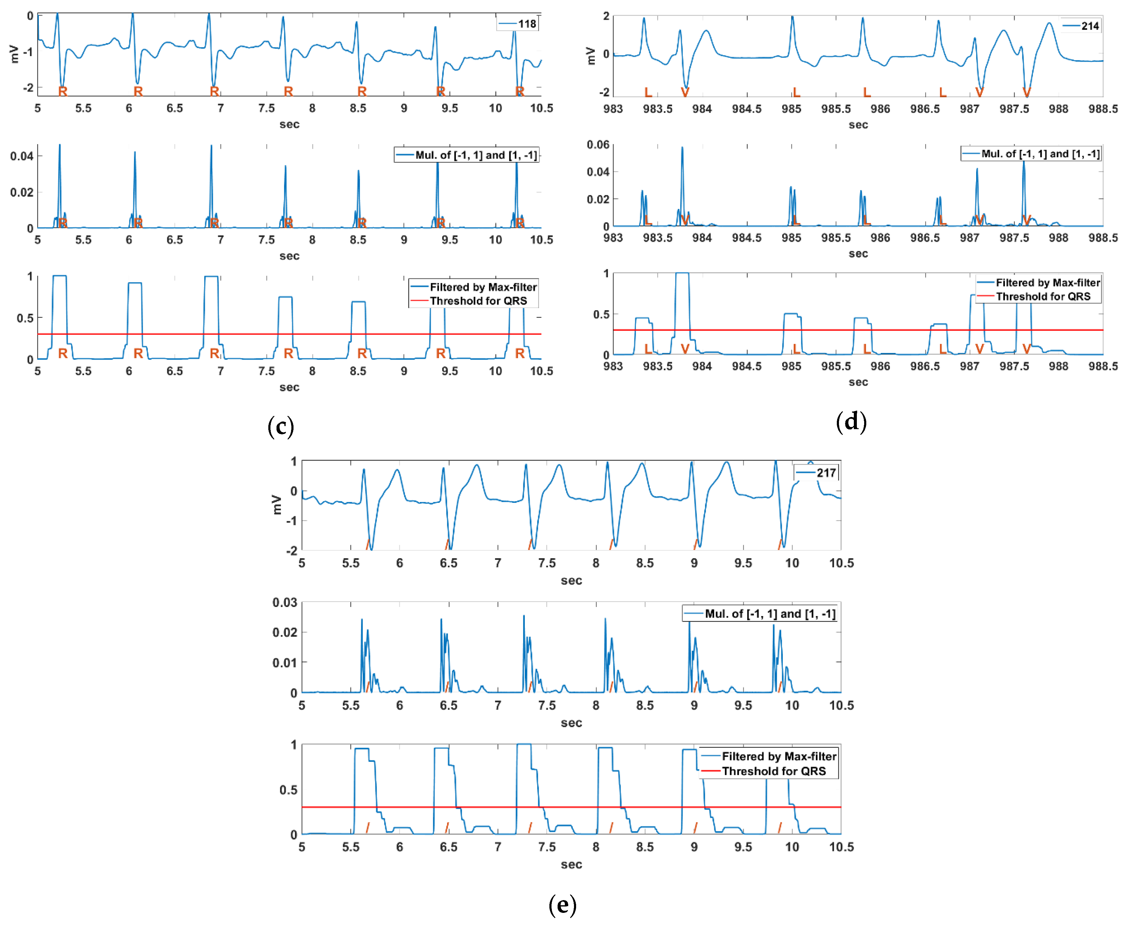 Efficient Real Time R And Qrs Detection Method Using A Pair Of Derivative Filters And Max Filter
