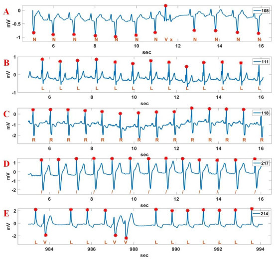 Efficient Real-Time R and QRS Detection Method Using a Pair of Derivative Filters and Max Filter ...