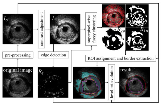 IVUS Image Segmentation Using Superpixel-Wise Fuzzy Clustering and Level Set Evolution