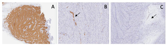 Fetal Megacystis: A New Morphologic, Immunohistological and ...