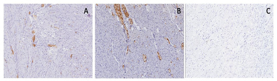 Fetal Megacystis: A New Morphologic, Immunohistological and ...