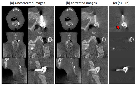 Metal Artifact Reduction in X-ray CT via Ray Profile Correction
