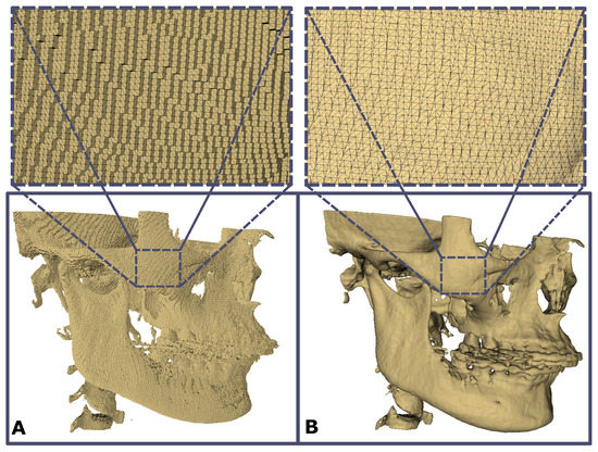 Automatic Method for Bone Segmentation in Cone Beam Computed Tomography ...