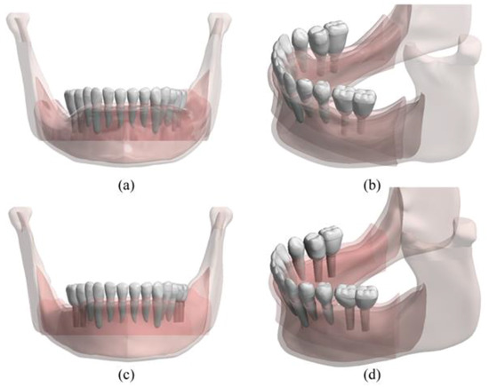 Virtual Bone Augmentation in Atrophic Mandible to Assess Optimal ...