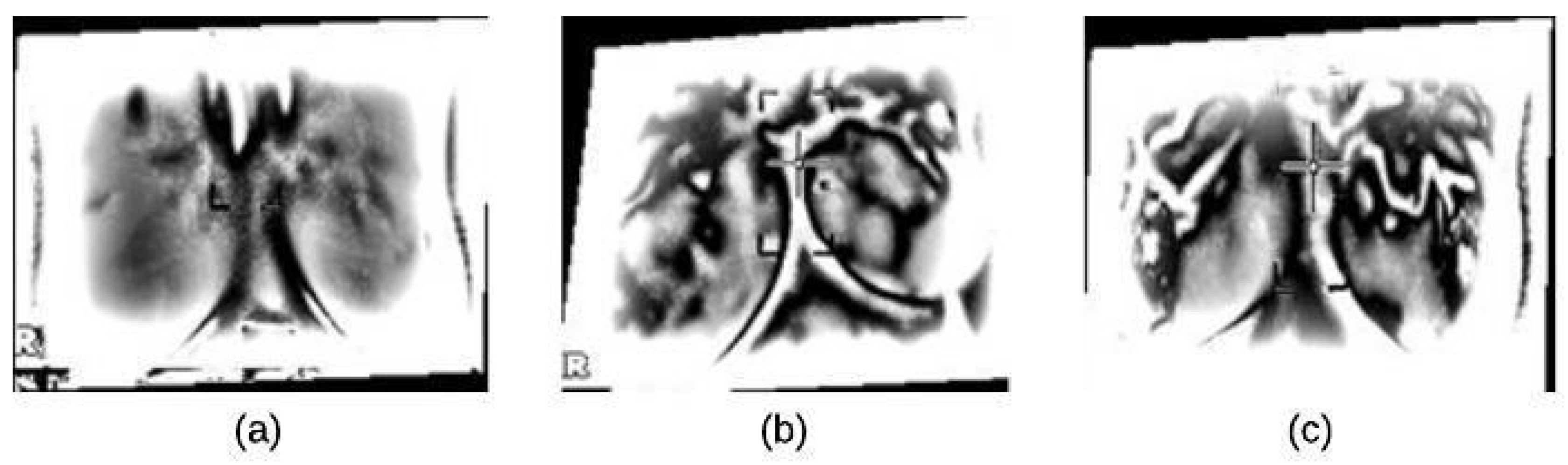 Thermogram Breast Cancer Detection: A Comparative Study of Two Machine ... Thermogram Breast Cancer Detection: A Comparative Study of Two Machine ...