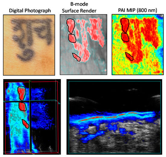 Photoacoustic Imaging of Tattoo Inks: Phantom and Clinical Evaluation