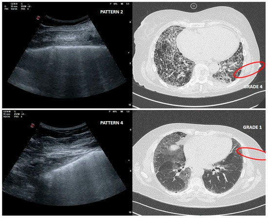 Possible Role of Chest Ultrasonography for the Evaluation of Peripheral ...