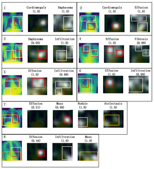 Automated Detection of Multiple Lesions on Chest X-ray Images ...