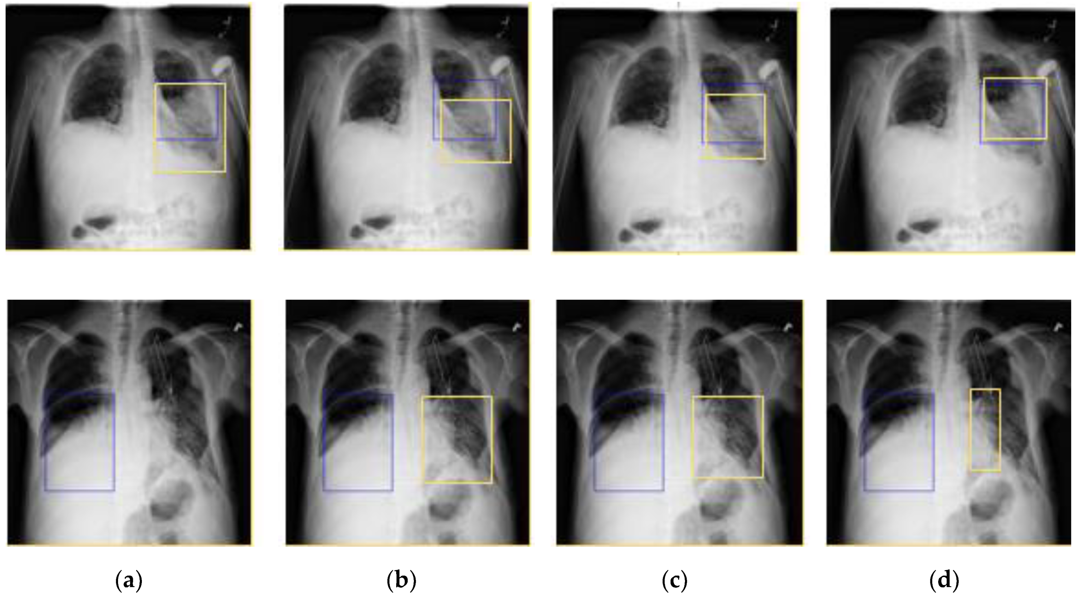 An Improved Algorithm for Detecting Pneumonia Based on YOLOv3