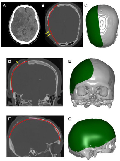 Three-Dimensional CAD in Skull Reconstruction: A Narrative Review with ...